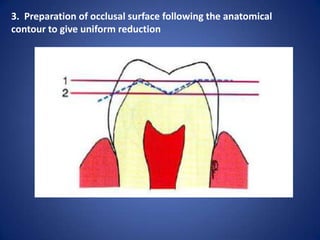 Principles of tooth preparation fixed orthodontic | PPTX