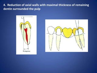 Principles of tooth preparation fixed orthodontic | PPTX