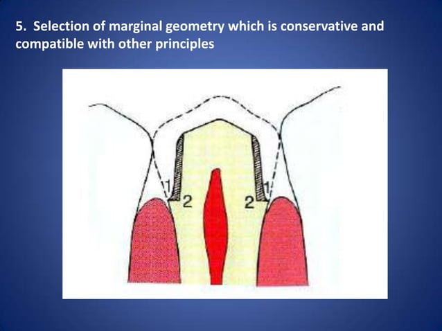 Principles of tooth preparation fixed orthodontic | PPTX | Dental ...