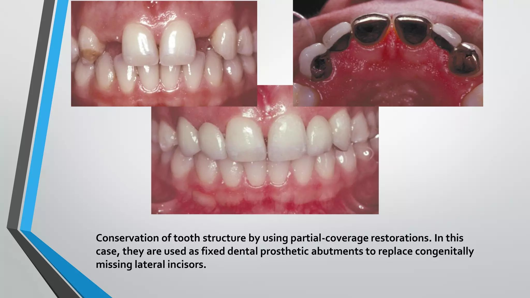 Principles of tooth preparation | PDF
