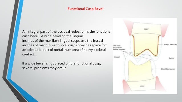 Principles of tooth preparation