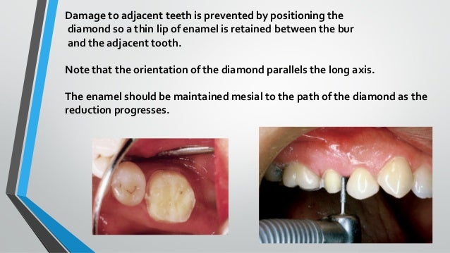 Principles of tooth preparation