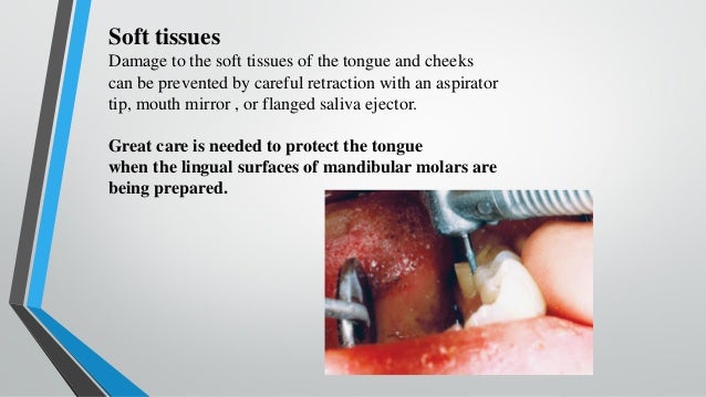 Principles of tooth preparation
