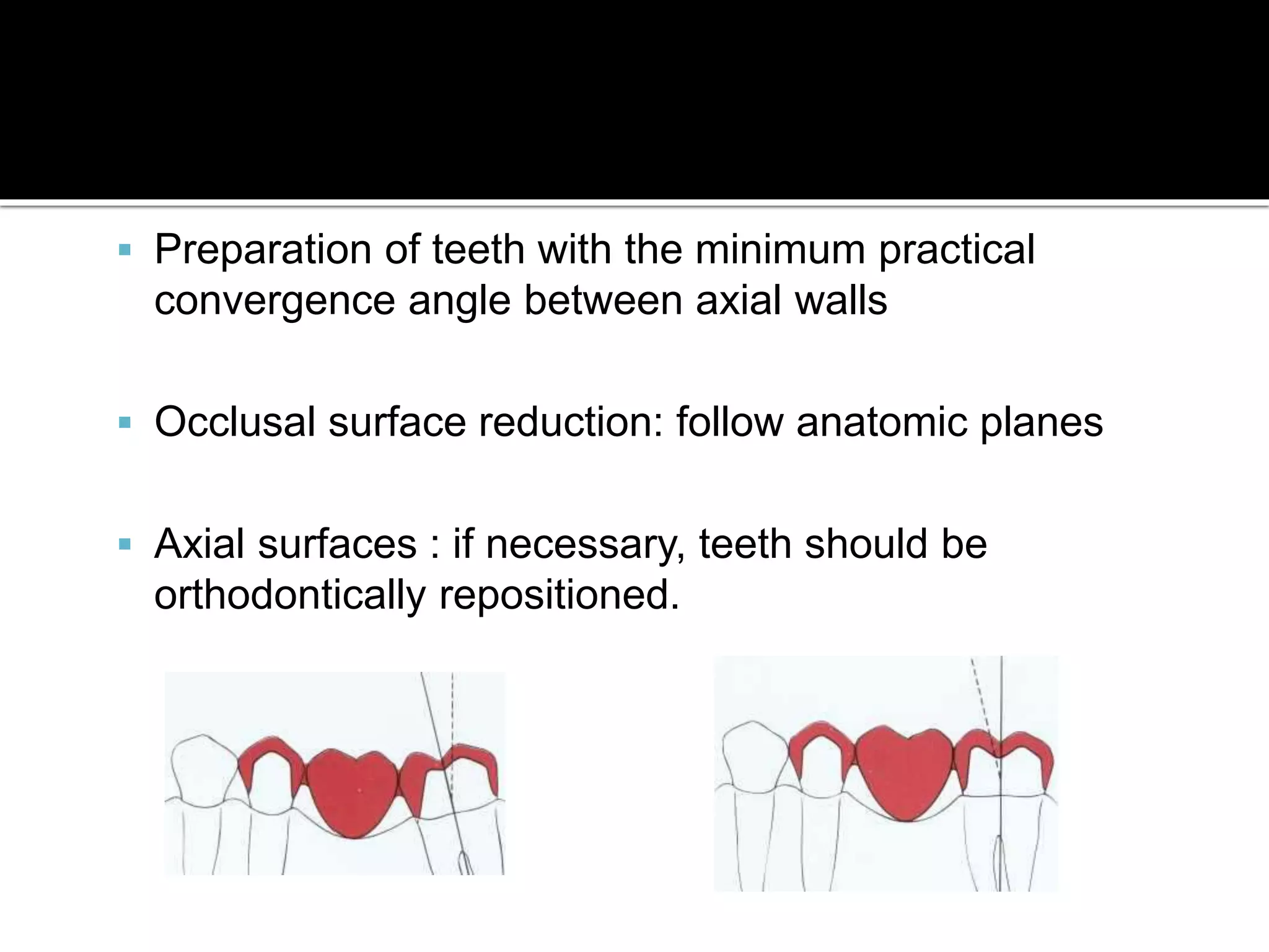 Principles of tooth preparation in Fixed Partial Dentures | PPTX