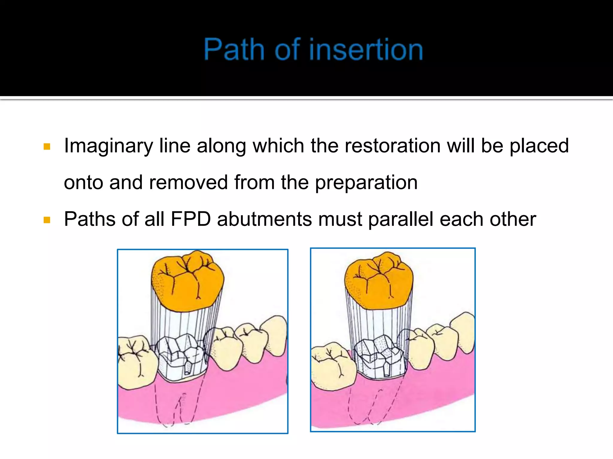 Principles of tooth preparation in Fixed Partial Dentures | PPTX