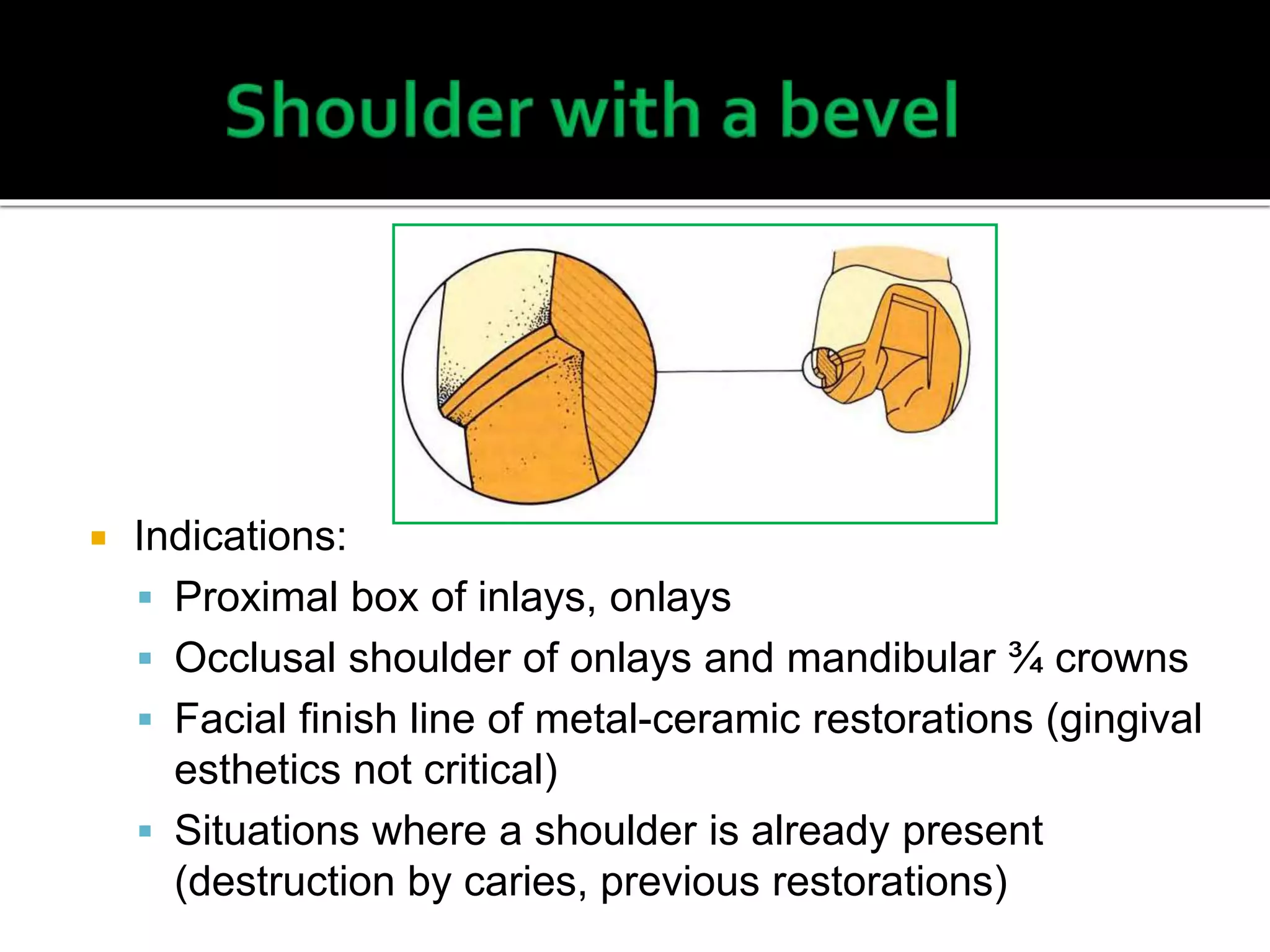 Principles of tooth preparation in Fixed Partial Dentures | PPTX