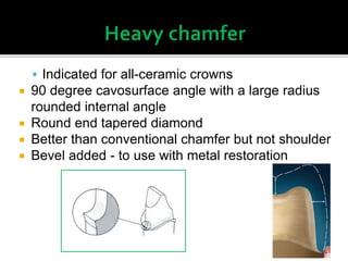Principles of tooth preparation in Fixed Partial Dentures | PPTX
