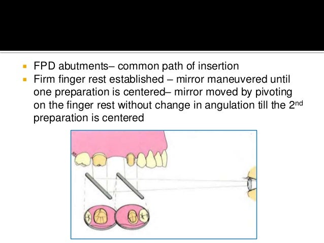 Principles of tooth preparation in Fixed Partial Dentures