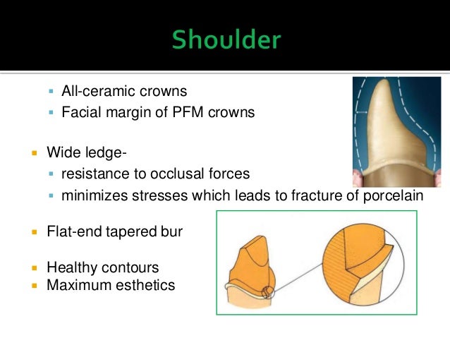 Principles of tooth preparation in Fixed Partial Dentures