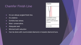 Principles of tooth preparation | PPTX