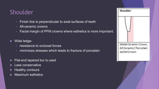 Principles of tooth preparation | PPTX