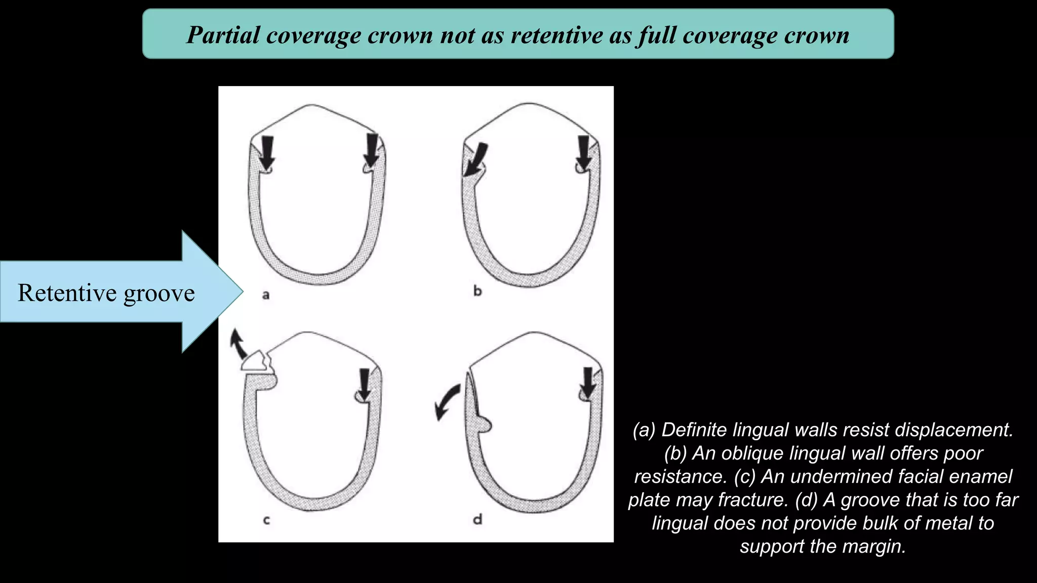 Principles of tooth preparation | PPTX