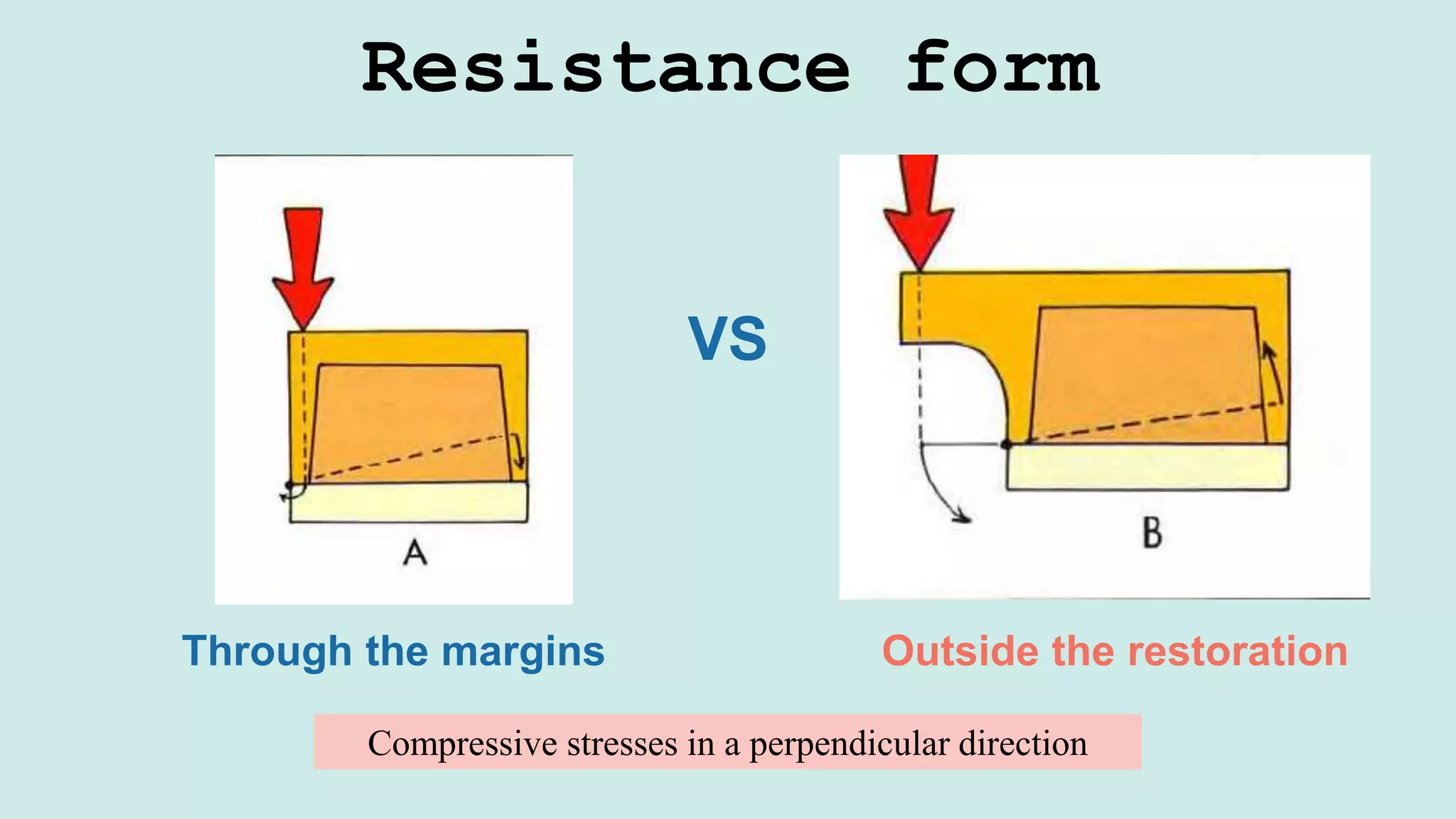 Principles of tooth preparation | PPTX