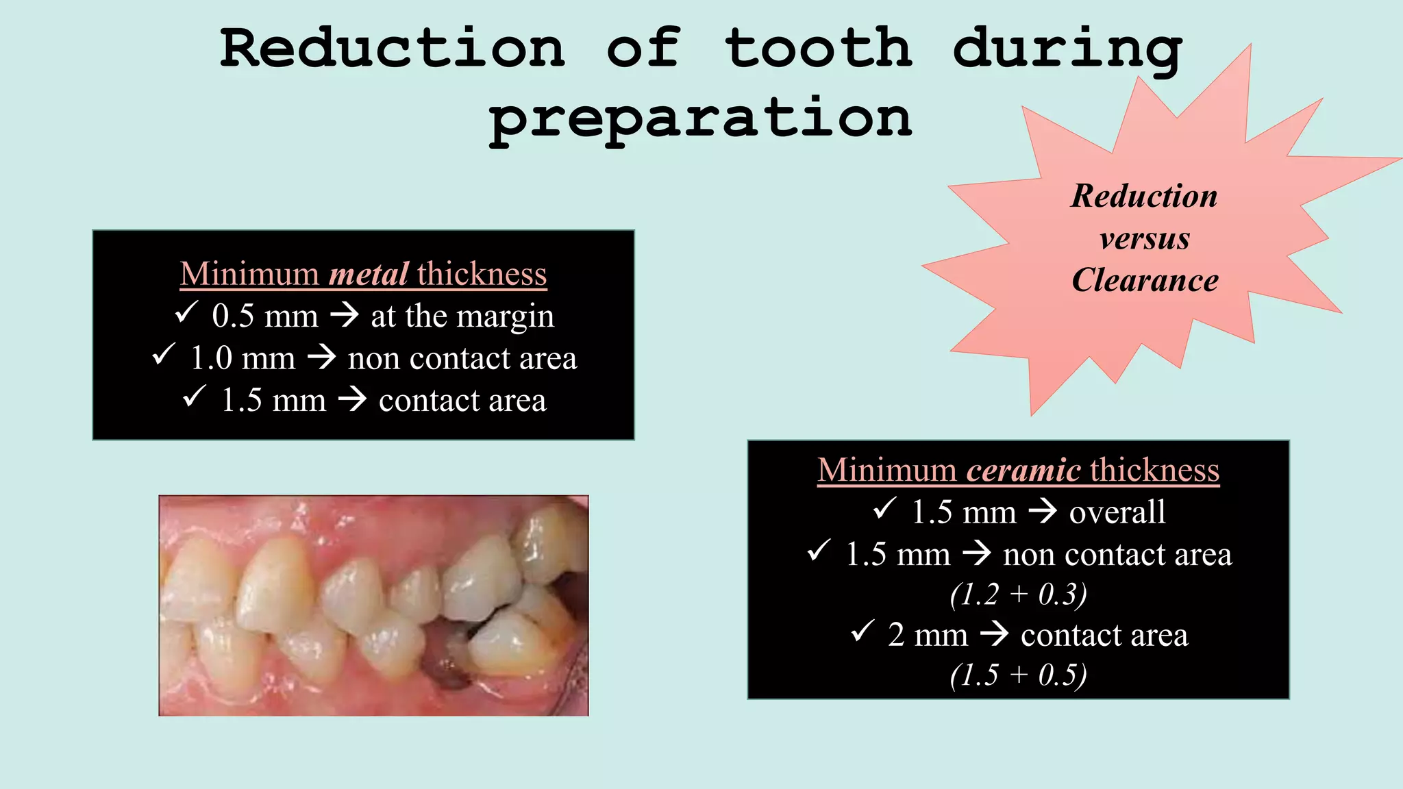 Principles of tooth preparation | PPTX