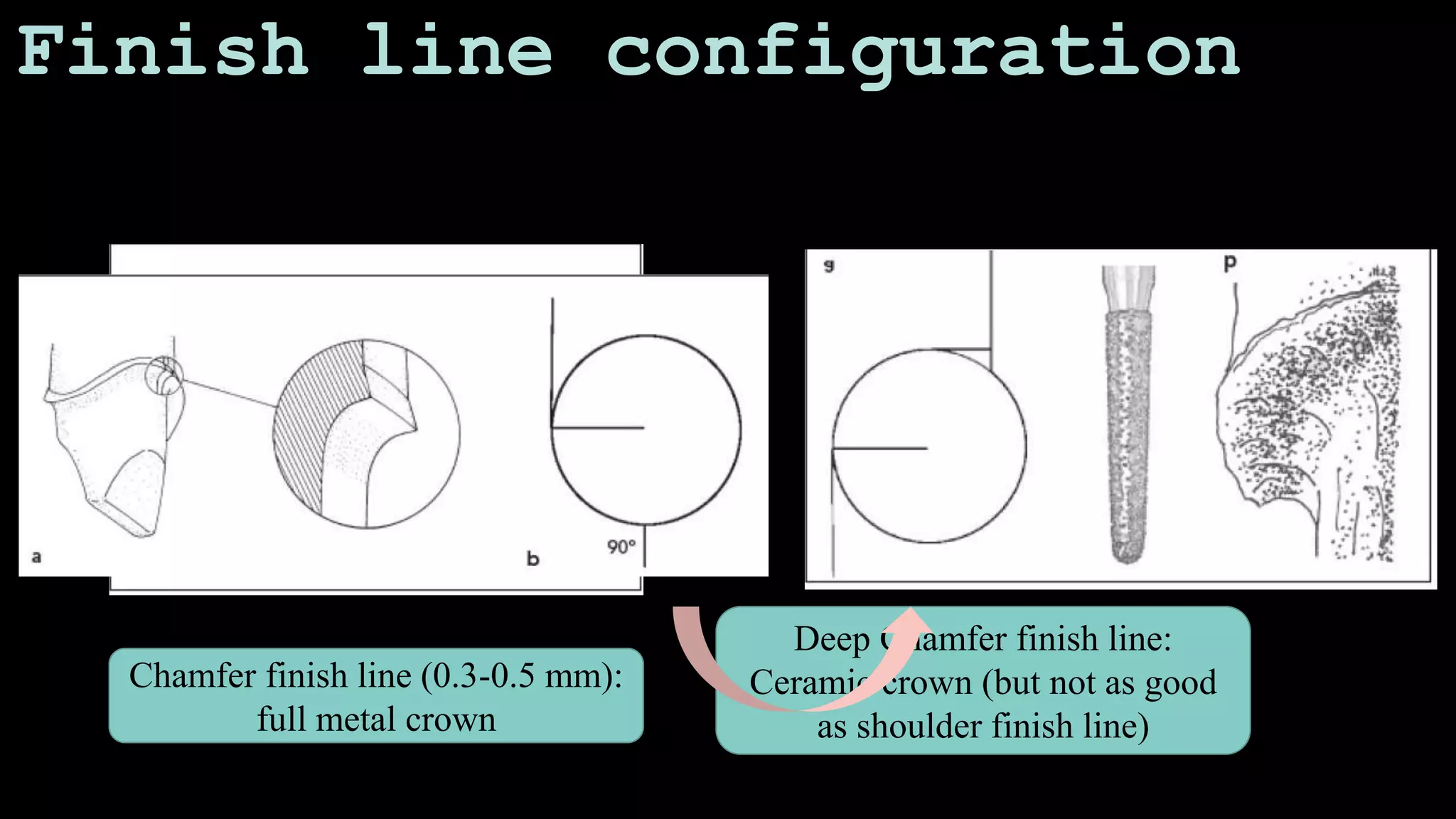 Principles of tooth preparation | PPTX