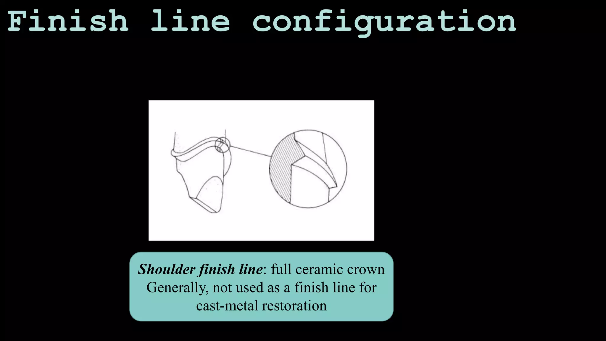 Principles of tooth preparation | PPTX
