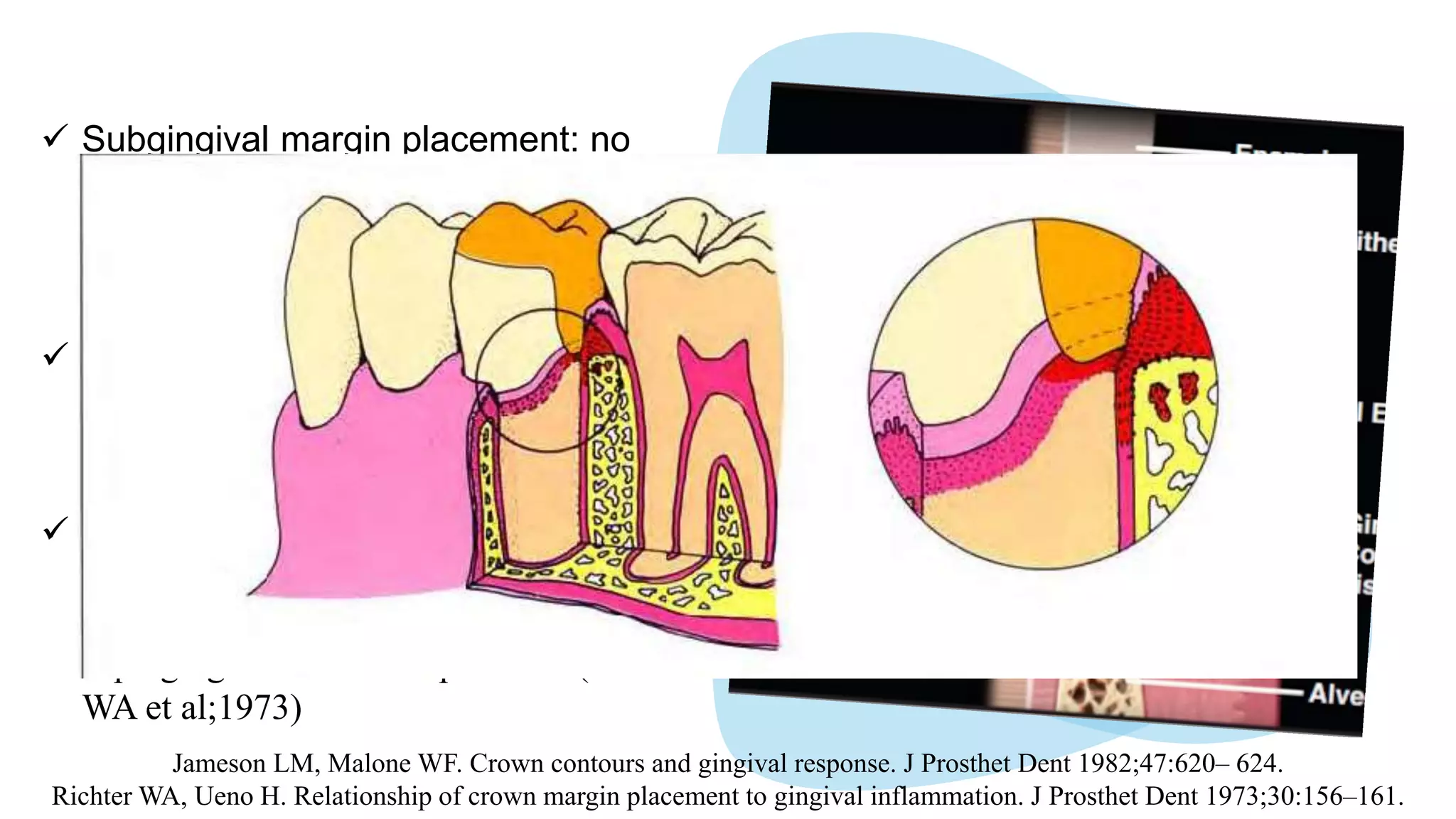 Principles of tooth preparation | PPTX