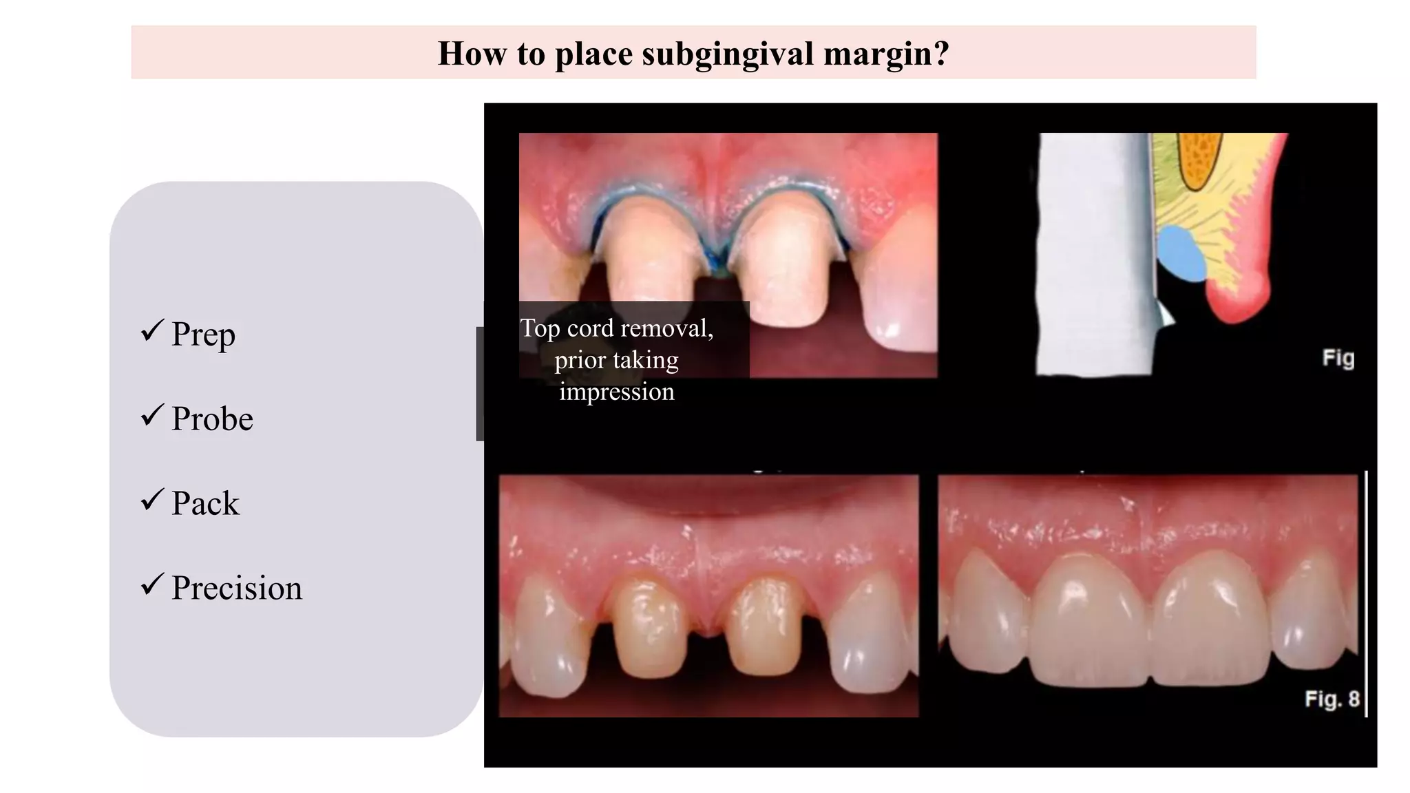 Principles of tooth preparation | PPTX