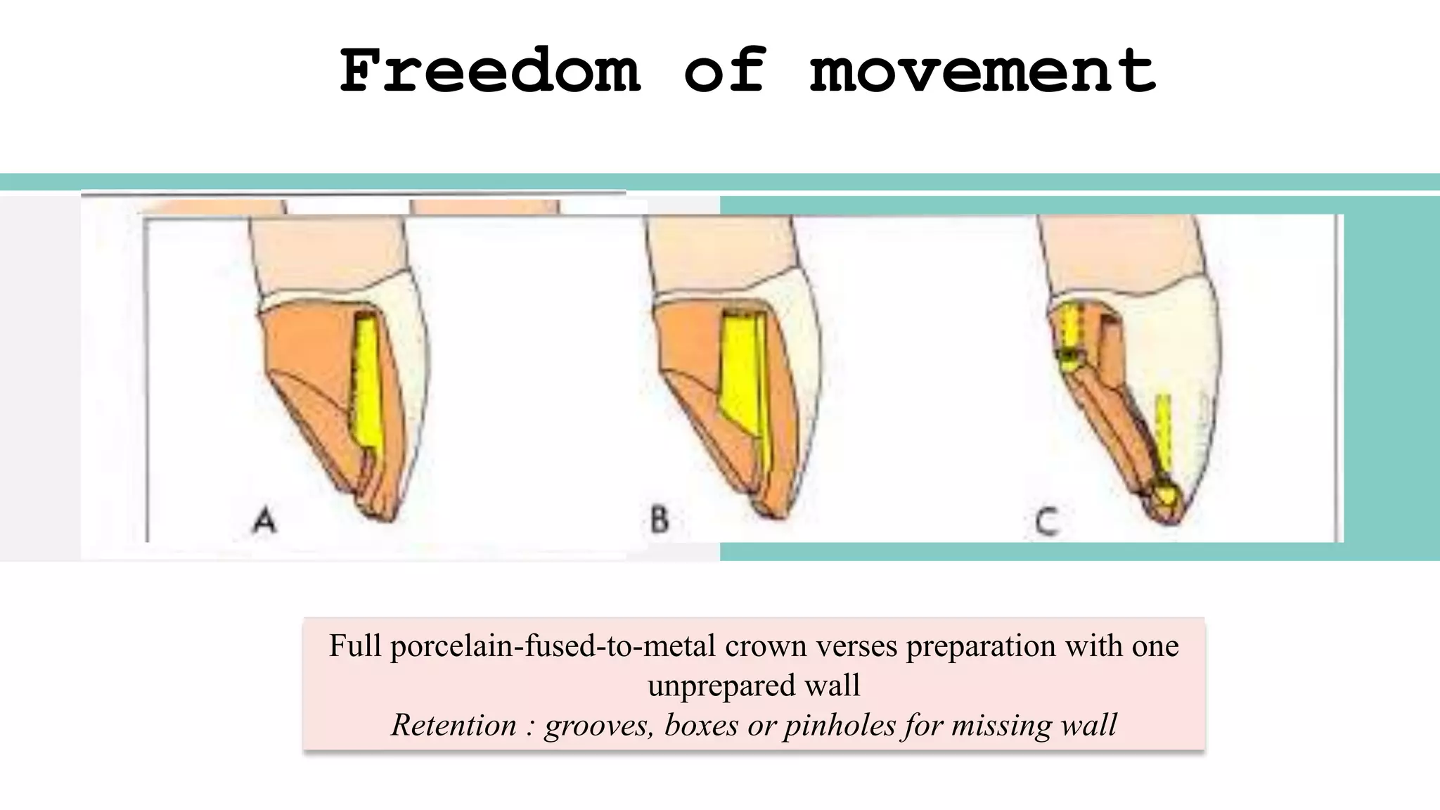 Principles of tooth preparation | PPTX