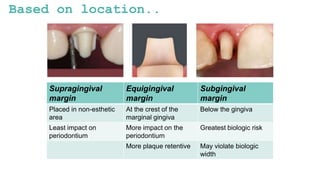 Principles of tooth preparation | PPTX