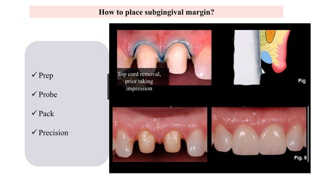 Principles of tooth preparation | PPTX