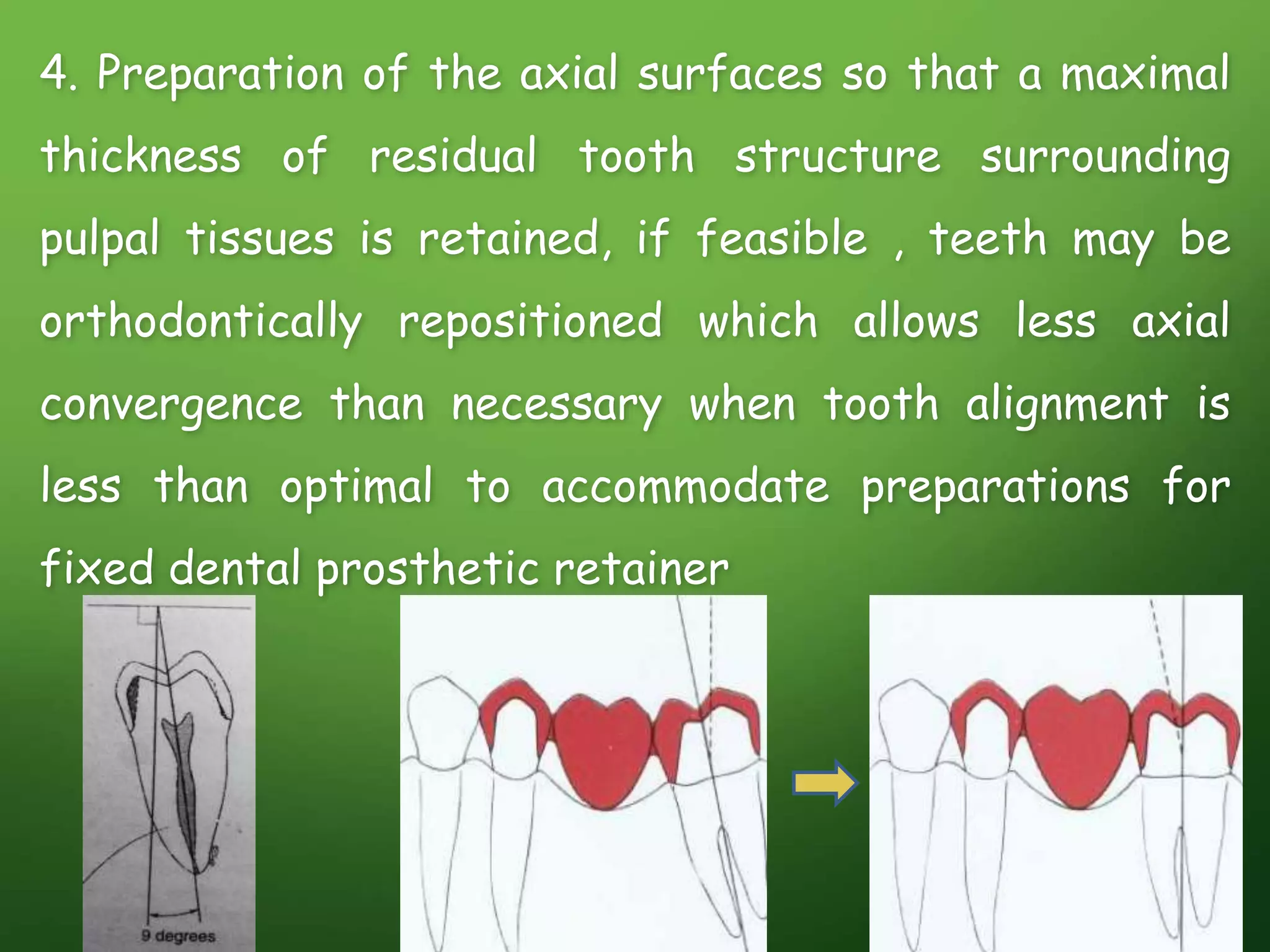 Principles of tooth preparation | PPTX | Dental Health | Diseases and Conditions