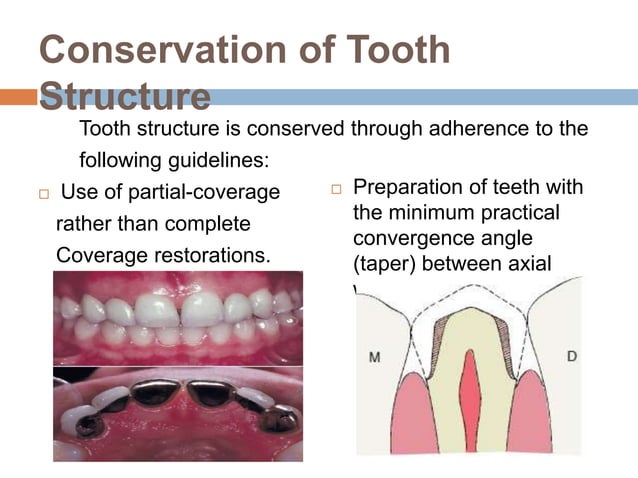 Principles of tooth preparation | PPTX
