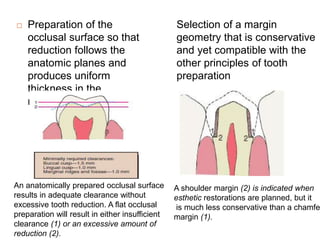 Principles of tooth preparation | PPTX