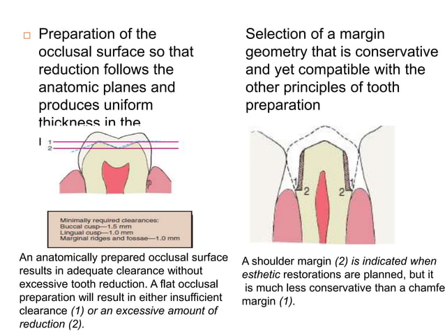 Principles of tooth preparation | PPTX