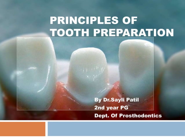 Principles of tooth preparation | PPTX