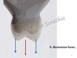 Principles of Tooth Preparation | PPTX