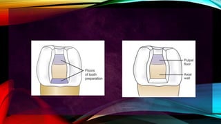 Principles of tooth preparation | PPTX