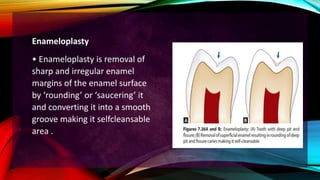 Principles of tooth preparation | PPTX