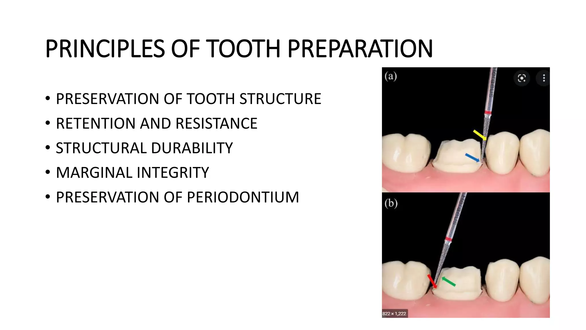 PRINCIPLES OF TOOTH PREPARATION.pptx | Dental Health | Diseases and Conditions