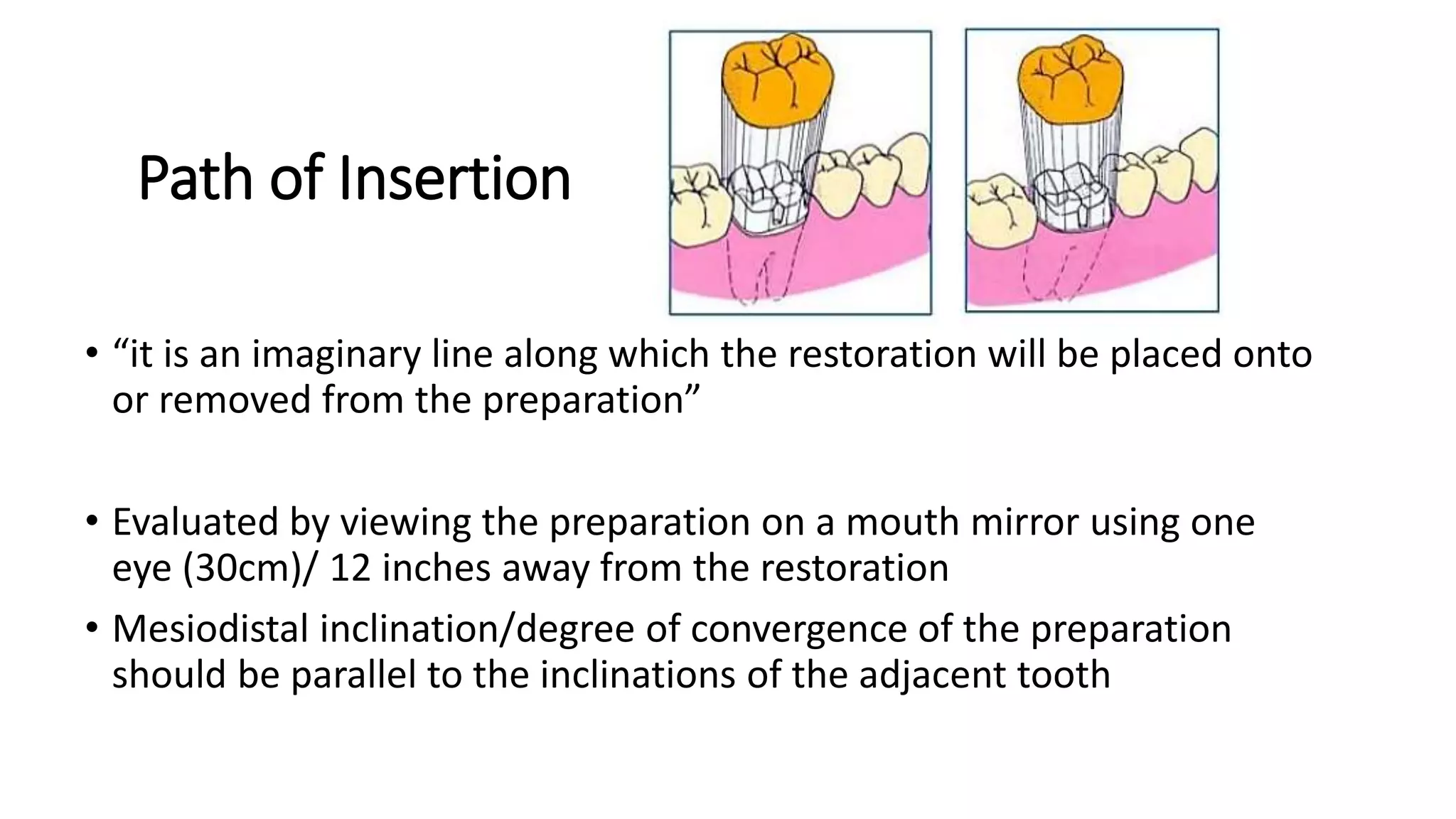 PRINCIPLES OF TOOTH PREPARATION.pptx