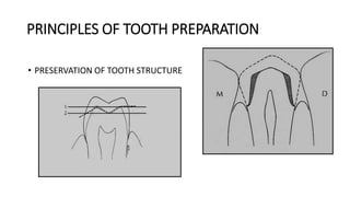 PRINCIPLES OF TOOTH PREPARATION.pptx