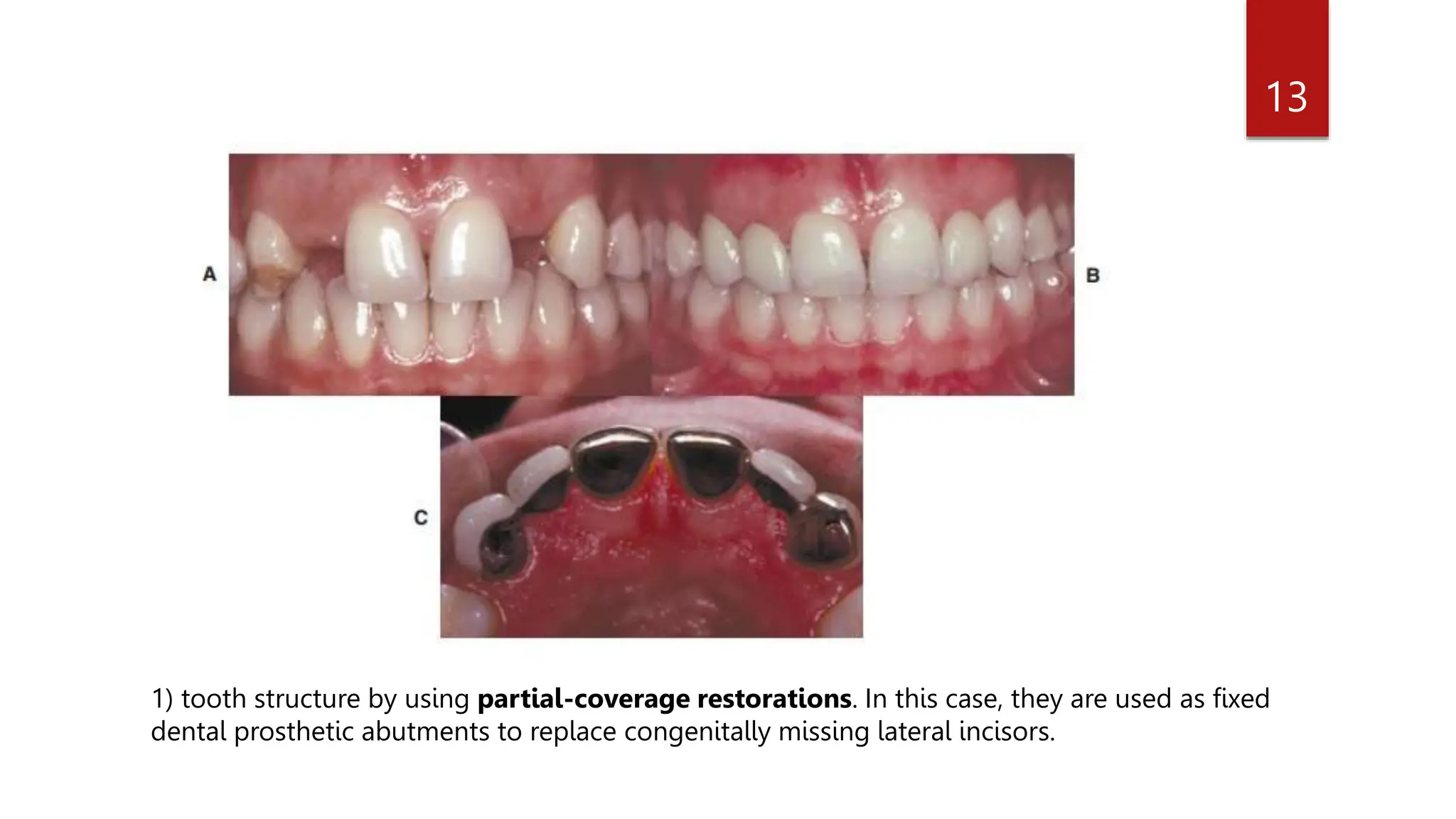 Principles Of Tooth Preparation.pptx