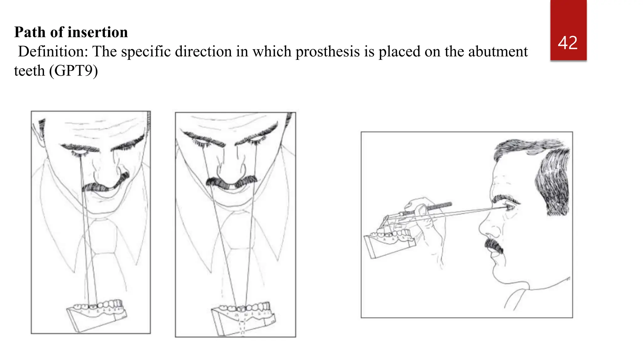 Principles Of Tooth Preparation.pptx