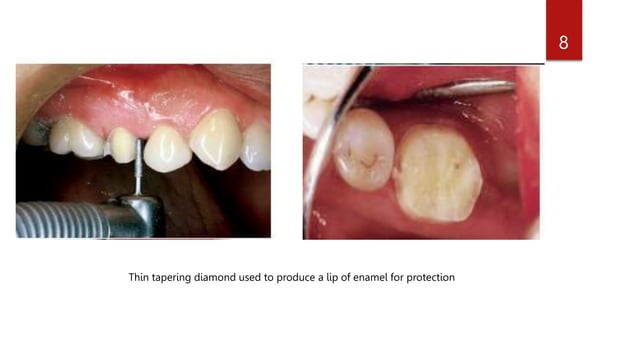 Principles Of Tooth Preparation.pptx | Oral care | Personal Care