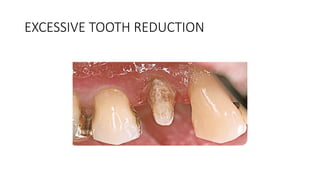 PRINCIPLES OF TOOTH PREPARATION for fixed Prosthodontics.pptx