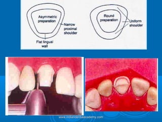 Principles of tooth preparation/ orthodontic seminars | PPT