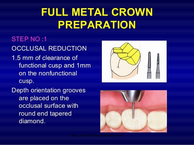Principles of tooth preparation (2)/ orthodontic seminars