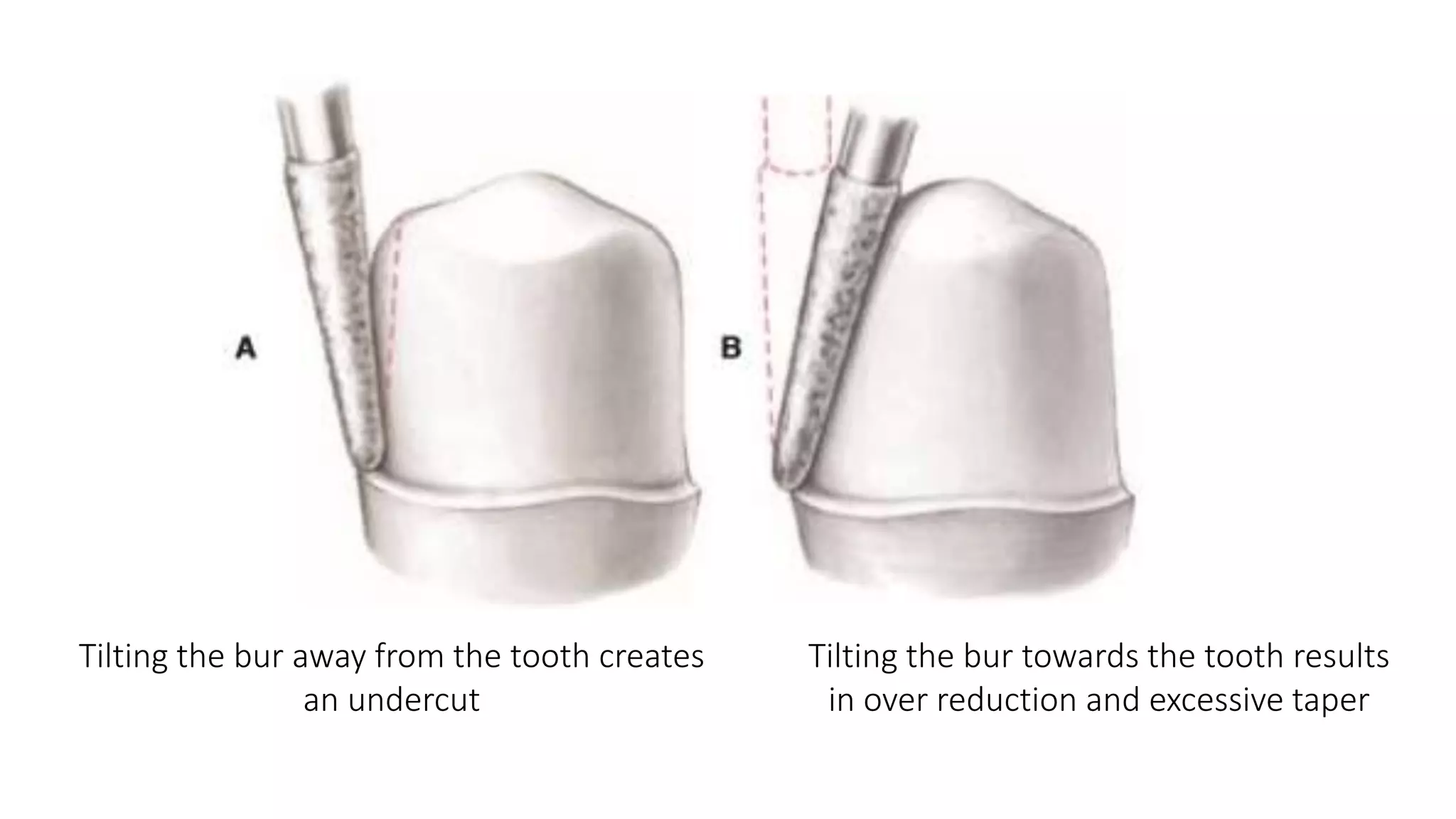 Principles of tooth preparation | PPTX