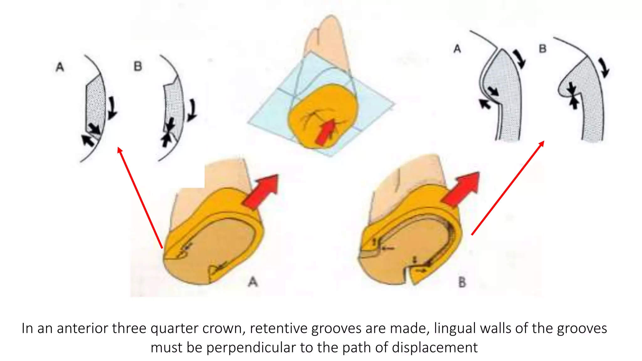 Principles of tooth preparation | PPTX