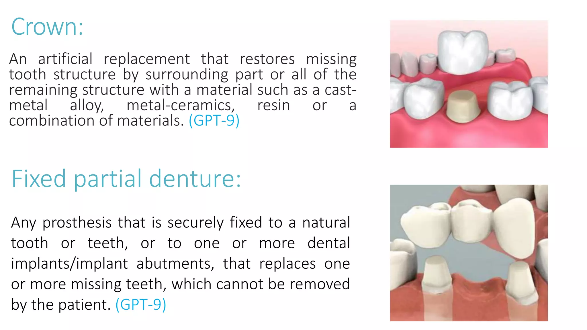 Principles of tooth preparation | PPTX