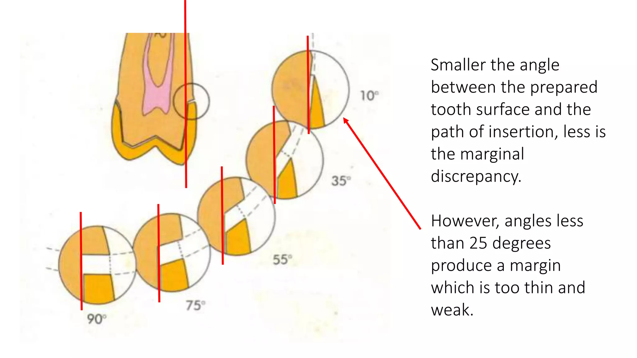 Principles of tooth preparation | PPTX