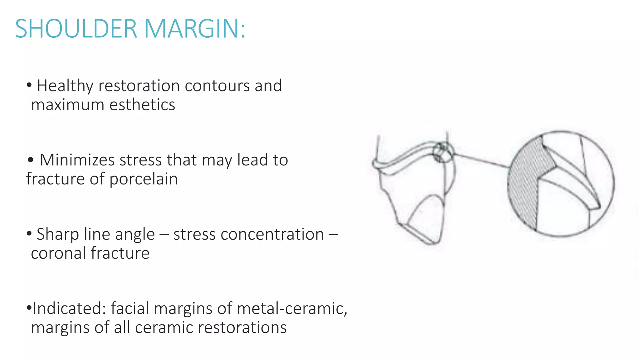 Principles of tooth preparation | PPTX