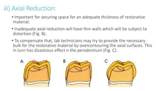 Principles of tooth preparation | PPTX