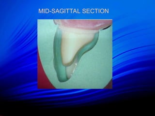 principles of tooth preperation 1.ppt Tooth | PPT