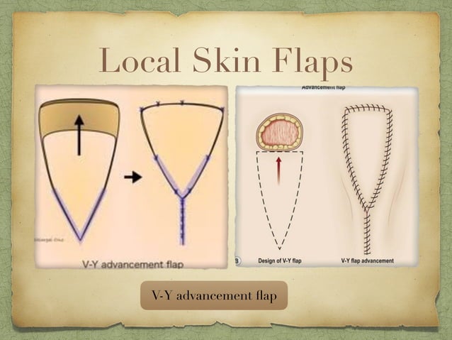 Principles of urethral reconstructive surgery | PDF | Skin and ...